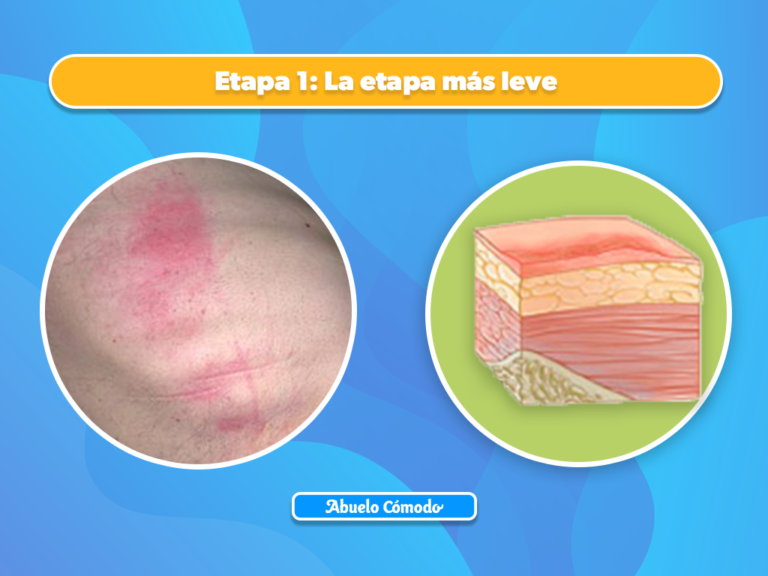 Escaras: conoce cada una de sus 4 etapas